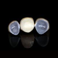 China Dental Alloy Metal Ceramic Crown Dental Restoration Porcelain Fused Metal Teeth for sale