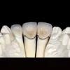 China Dental Alloy Metal Ceramic Crown Dental Restoration Porcelain Fused Metal Teeth for sale