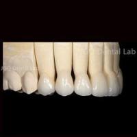 China Customized Chinese Dental Lab Zirconia Teeth Precision Overall Dental Restoration for sale