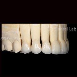 China Customized Chinese Dental Lab Zirconia Teeth Precision Overall Dental Restoration for sale