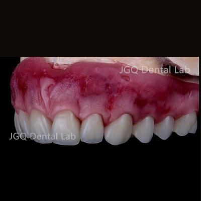 China 3D Printer Zirconia Crown and Bridge Hybrid Dental Implant with Titanium Abutment for sale