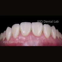 China 3D Printer Zirconia Crown and Bridge Hybrid Dental Implant with Titanium Abutment for sale
