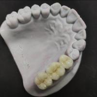 China CE Certified Zirconia Dental Crown with 3D Laser Printing and Customized Design for sale