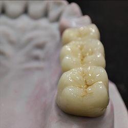 China Multilayer Shade Zirconia Ceramic Build up Dentures Crown and Bridge Dental Lab Supplies for sale