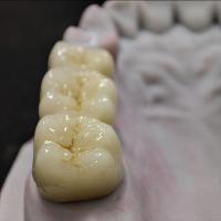 China Custom China Dental Lab Hand Tailor Full Ceramic Crowns Free End for sale