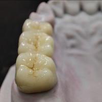 China Custom China Dental Lab Hand Tailor Full Ceramic Crowns Free End for sale