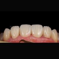 China Full Mouth Dental Implant Bridge Customized Implanting Guide For Oral Restoration for sale