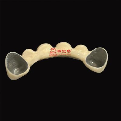 China Customized Pfm Titanium Teeth Durable Corrosion Resistant Ensuring Longevity for sale