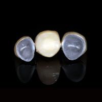 China Customized Pfm Titanium Teeth Durable Corrosion Resistant Ensuring Longevity for sale