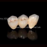 China Customized Pfm Titanium Teeth Durable Corrosion Resistant Ensuring Longevity for sale
