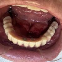 China 3D Printer Zirconia Crown and Bridge Hybrid Dental Implant with Titanium Abutment for sale