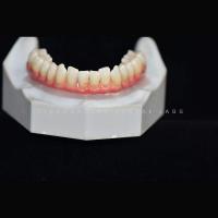 China Dental Implants Restoration Dental Zirconia Screw Crown Implant for sale