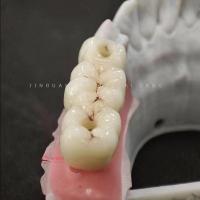 China Dental Implants Restoration Dental Zirconia Screw Crown Implant for sale
