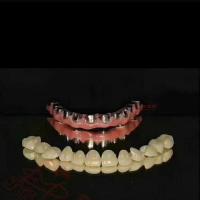 China Titanium Abutment Dental Implant Screw Retained Crown 3D Laser Printing Customized for sale