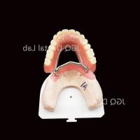 China Customized Hybrid Dental Implants Hybrid Denture With Titanium Bar for sale