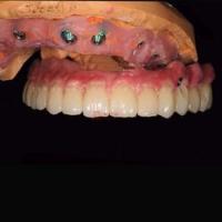 China Customized Hybrid Dental Implants Hybrid Denture With Titanium Bar for sale