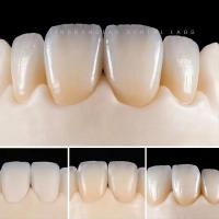 China Customized High-Quality Zirconia Dentures Crafted with Precision for Superior Durability and Aesthetic Appeal From Jgq Dental Lab for sale