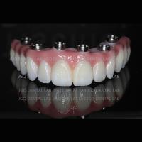 China Titanium Abutments Dental Implant Screw Retained Crown For Dental Restoration for sale
