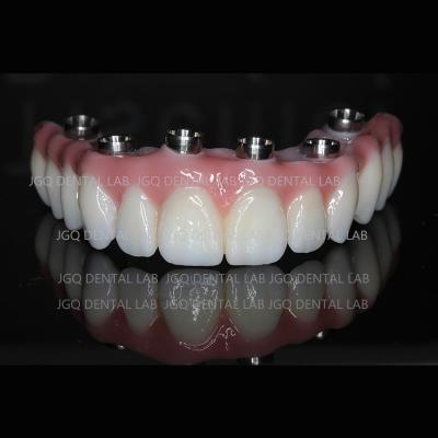China Titanium Abutments Dental Implant Screw Retained Crown For Dental Restoration for sale