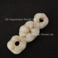 China Titanium Abutments Dental Implant Screw Retained Crown For Dental Restoration for sale