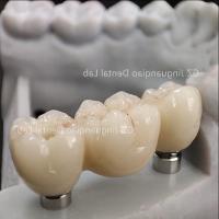 China Dental Implant Screw Retained Crowns Titanium Bar Implant Supported Hybrid Denture for sale