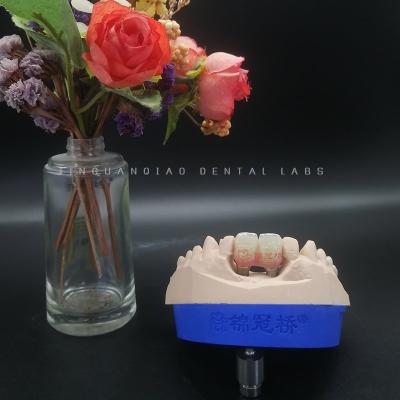 China Dental Implant Screw Retained Crowns Titanium Bar Implant Supported Hybrid Denture for sale