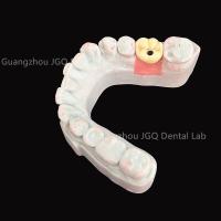 China Dental Implant Screw Retained Crowns Titanium Bar Implant Supported Hybrid Denture for sale