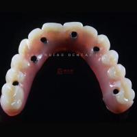 China Snap in Implant Dentures Hybrid Dental Implant Restoration Screwed Retention for Dental Lab for sale