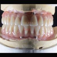China Snap in Implant Dentures Hybrid Dental Implant Restoration Screwed Retention for Dental Lab for sale