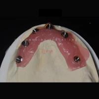 China Snap in Implant Dentures Hybrid Dental Implant Restoration Screwed Retention for Dental Lab for sale