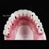 China Implanted Dentures Manufacturer Customized Implant Teeth Bridge with Real Bite Sensation for Oral Restoration for sale
