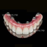 China Implanted Dentures Manufacturer Customized Implant Teeth Bridge with Real Bite Sensation for Oral Restoration for sale