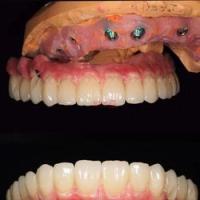 China CE FDA Certified Superior Quality and Performance Dental Implants Zirconia Crowns and Customized Titanium Abutment for sale