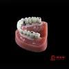 China Customized Hybrid Dental Implants Hybrid Denture With Titanium Bar for sale