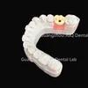 China Dental Lab Durability Implants Make Cost-Effective Option in The Long Run for sale