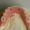China Choose China Dental Implants for Permanent and Reliable Solution to Missing Teeth with Wholesale Prices for sale