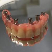 China Choose China Dental Implants for Permanent and Reliable Solution to Missing Teeth with Wholesale Prices for sale