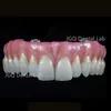 China Customized Implant Teeth Bridge Implanting Guide Look Like Natural Teeth Restore Oral Health, Function and Appearance for sale