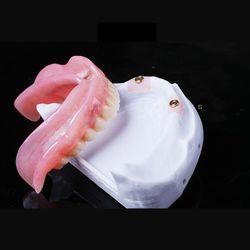 China Ball-Cap Implant Overdenture Offers Excellent Stability and Retention Suitable for Elderly Patients Lab Prices for sale