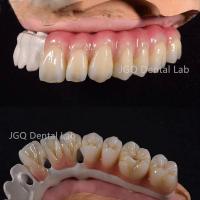 China All On 6 Dental Implants Fixed Dentures Dental Lab All Ceramic FDA CE Certificated for sale