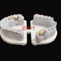 China Customized Dental Crown and Implant with CE FDA Certification Using 3D Laser Printing Technology for sale