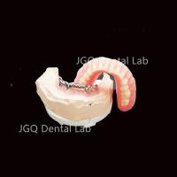 China All on 4 Dental Implant Titanium Bar Dentures Restorations for sale