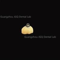 China Customized Titanium Abutment Implanted Dentures for Durable Dental Solutions for sale