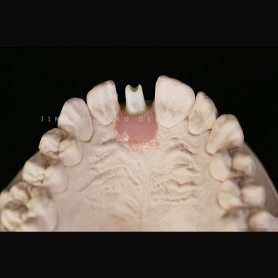 China Dental Implant Restorations Custom Titanium Zirconia Abutment En China Dental Lab for sale