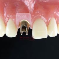 China Dental Implant Restorations Custom Titanium Zirconia Abutment En China Dental Lab for sale