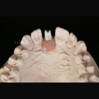 China Dental Implant Restorations Custom Titanium Zirconia Abutment En China Dental Lab for sale