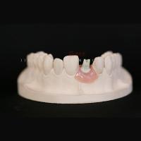 China Custom Dental Implant Screw Retained Crown Hybrid Dentures Zirconia Angled Abutment China Lab for sale