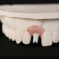 China Custom Dental Implant Screw Retained Crown Hybrid Dentures Zirconia Angled Abutment China Lab for sale