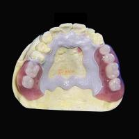 China 3D Printing Peek Frame Removable Dentures Acrylic Teeth China Dental Lab for sale