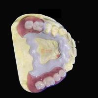 China 3D Printing Peek Frame Removable Dentures Acrylic Teeth China Dental Lab for sale
